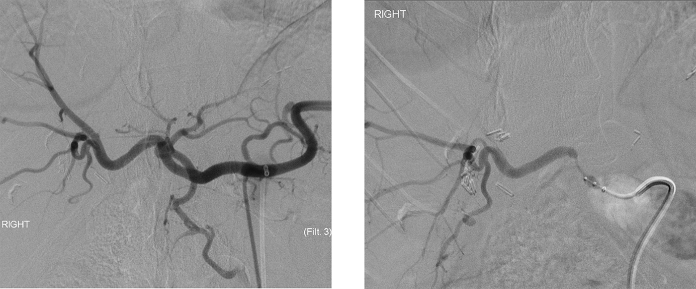 Y-90 radioembolization for liver cancer - Book chapter - IOPscience