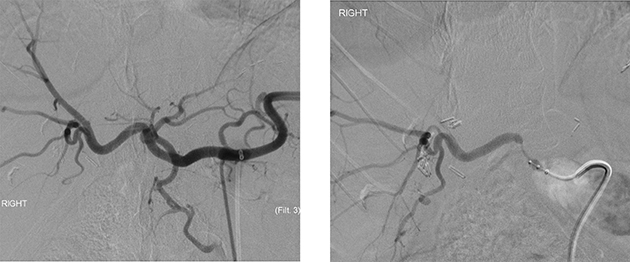 Y-90 radioembolization for liver cancer - Book chapter - IOPscience