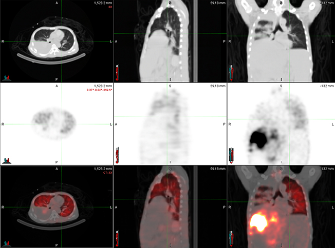 Y-90 radioembolization for liver cancer - Book chapter - IOPscience