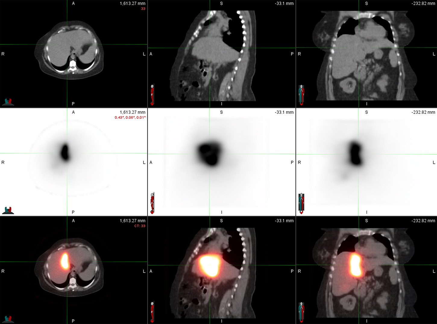 Y-90 radioembolization for liver cancer - Book chapter - IOPscience