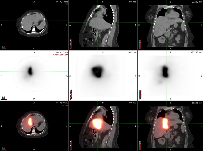 Y-90 radioembolization for liver cancer - Book chapter - IOPscience