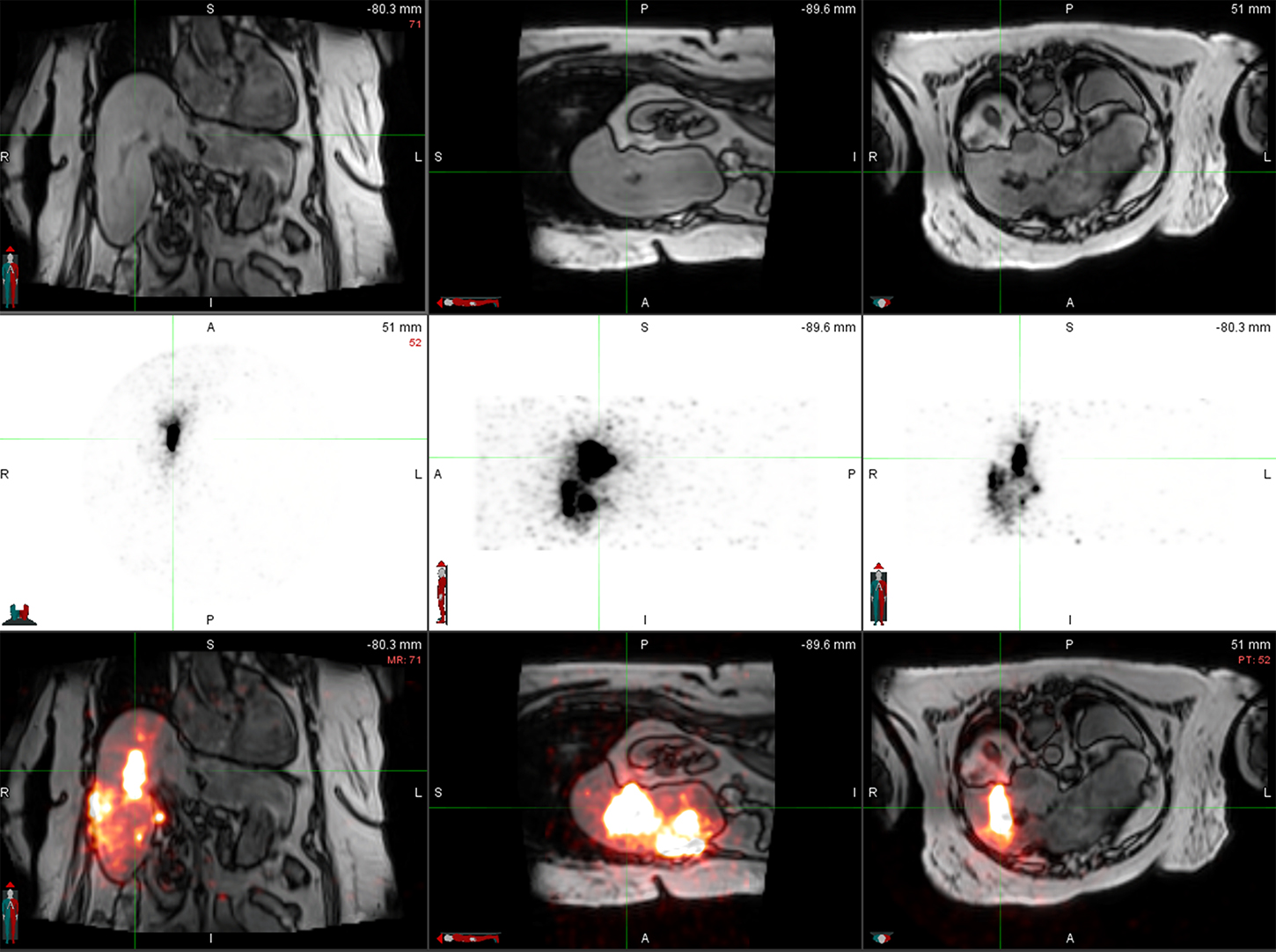 Y-90 radioembolization for liver cancer - Book chapter - IOPscience