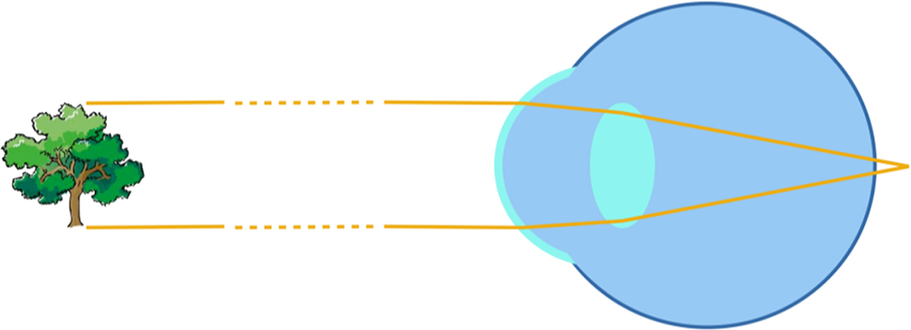 The human eye and refractive correction - Book chapter - IOPscience