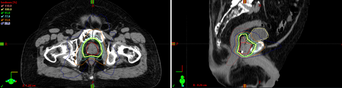 Artificial Intelligence in prostate cancer treatment with image-guided ...