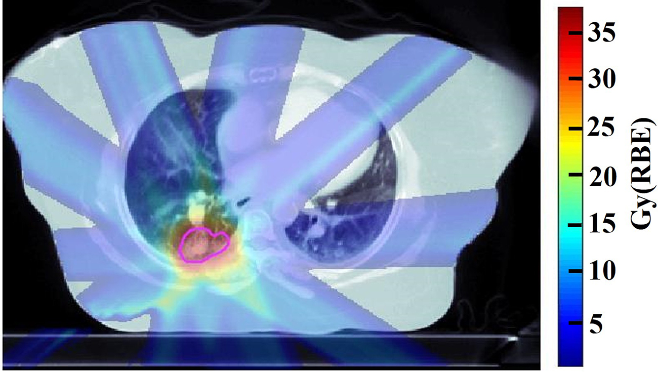 Proton beam spatially fractionated radiation therapy: clinical data ...