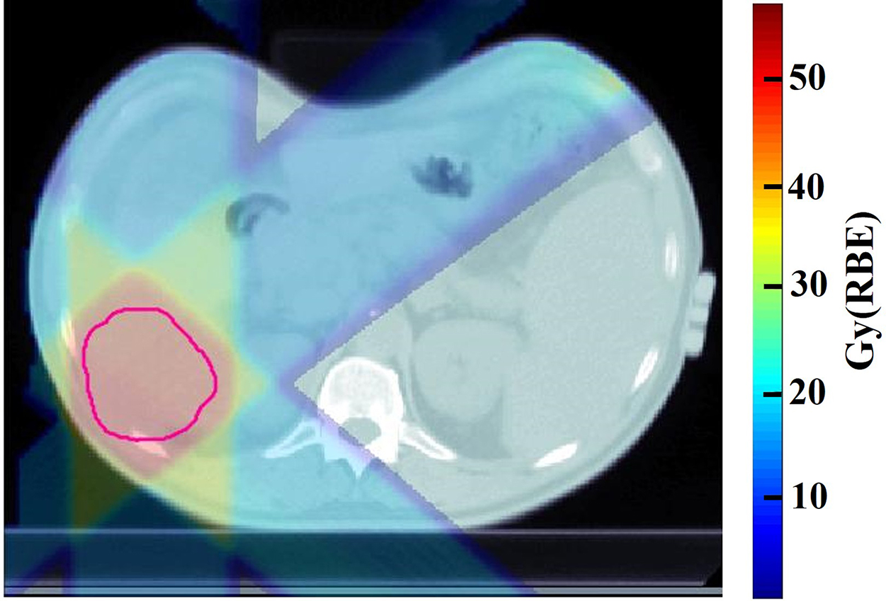 Proton beam spatially fractionated radiation therapy: clinical data ...