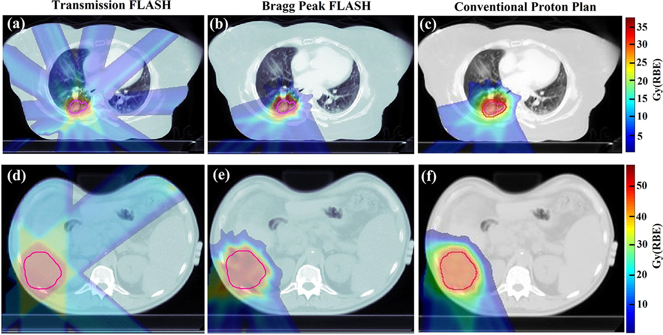 Proton beam spatially fractionated radiation therapy: clinical data ...
