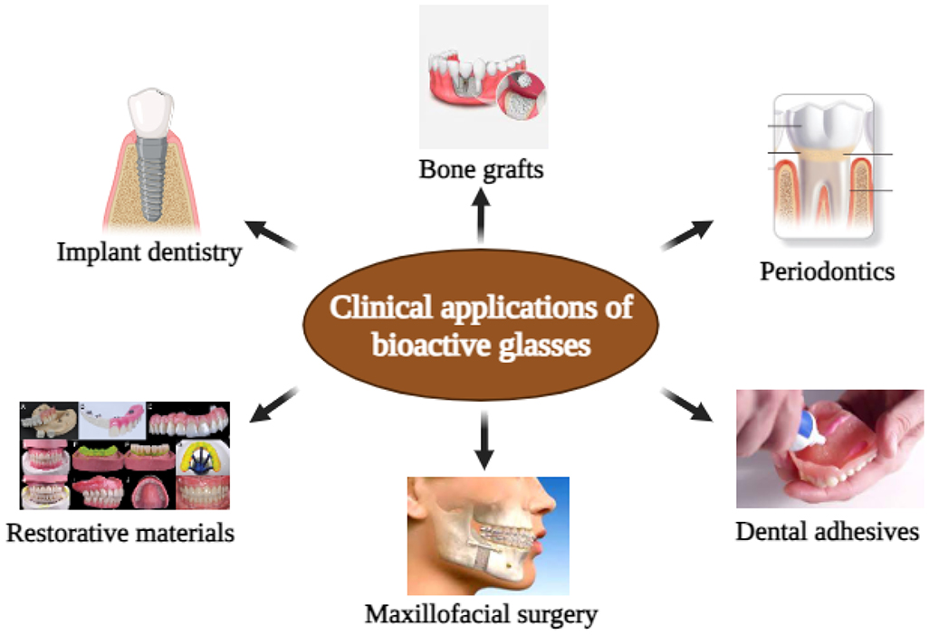 Revolutionizing dentistry applications of bioactive glass Book chapter IOPscience