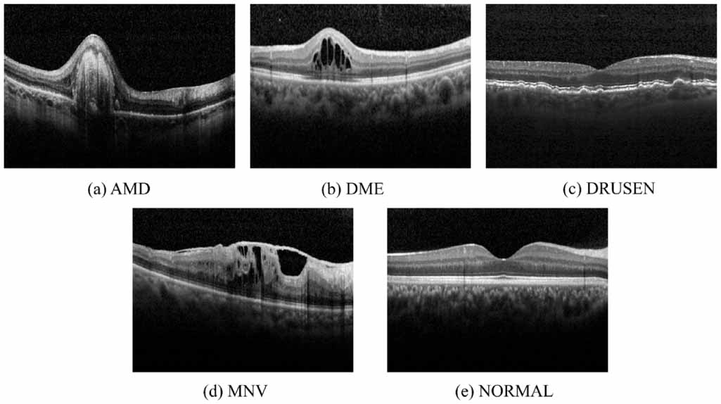 MobilenetV2-RC: a lightweight network model for retinopathy ...