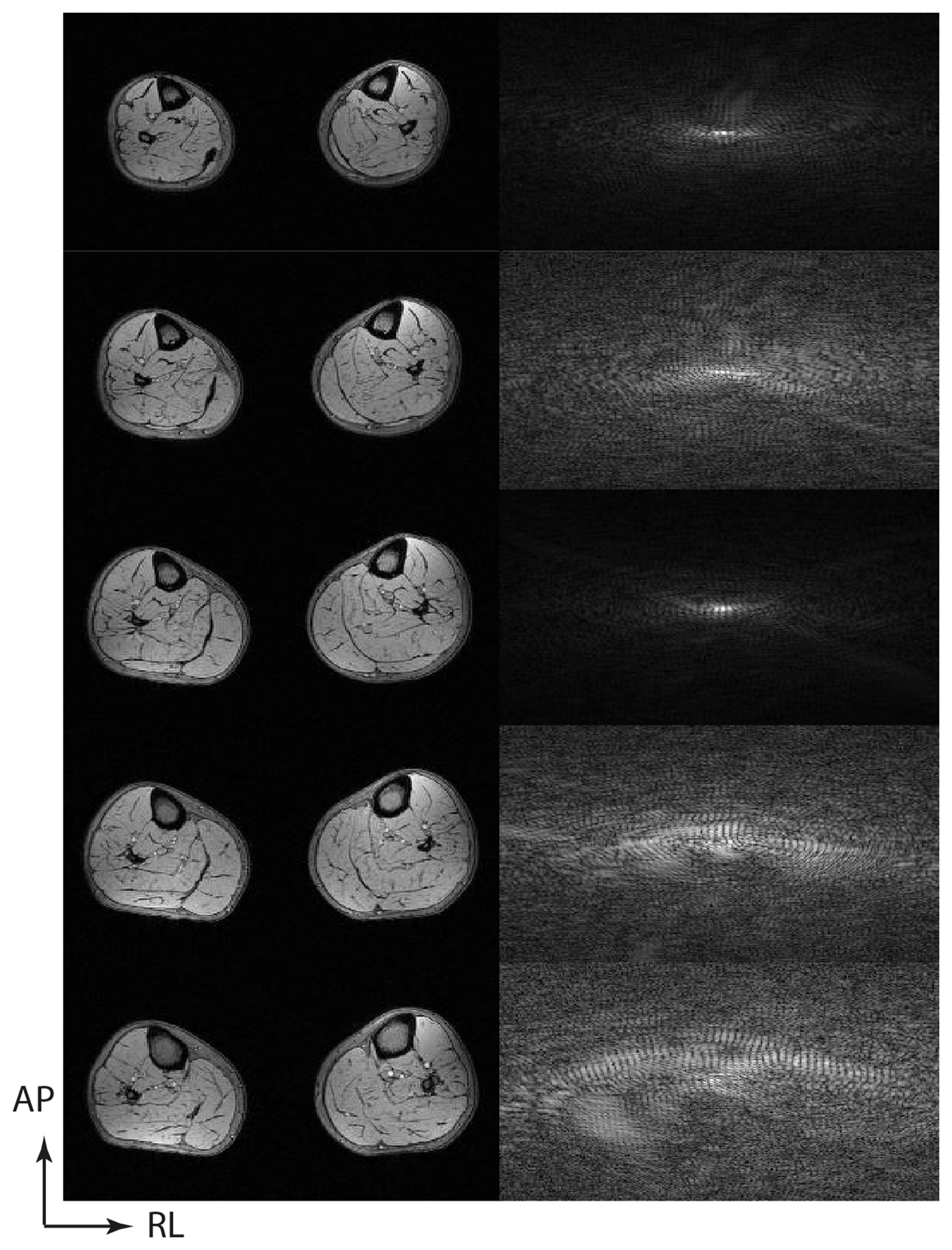 Reducing acquisition time in clinical MRI by data undersampling and compressed sensing ...