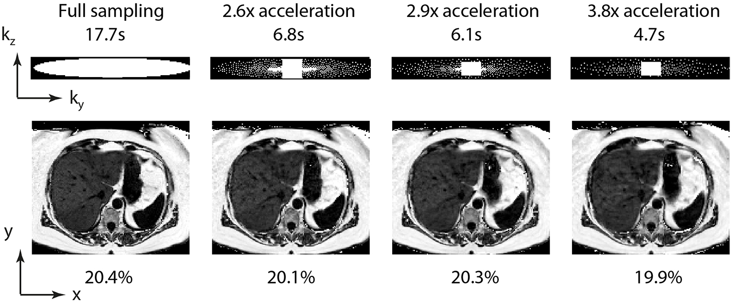 Reducing acquisition time in clinical MRI by data undersampling and ...