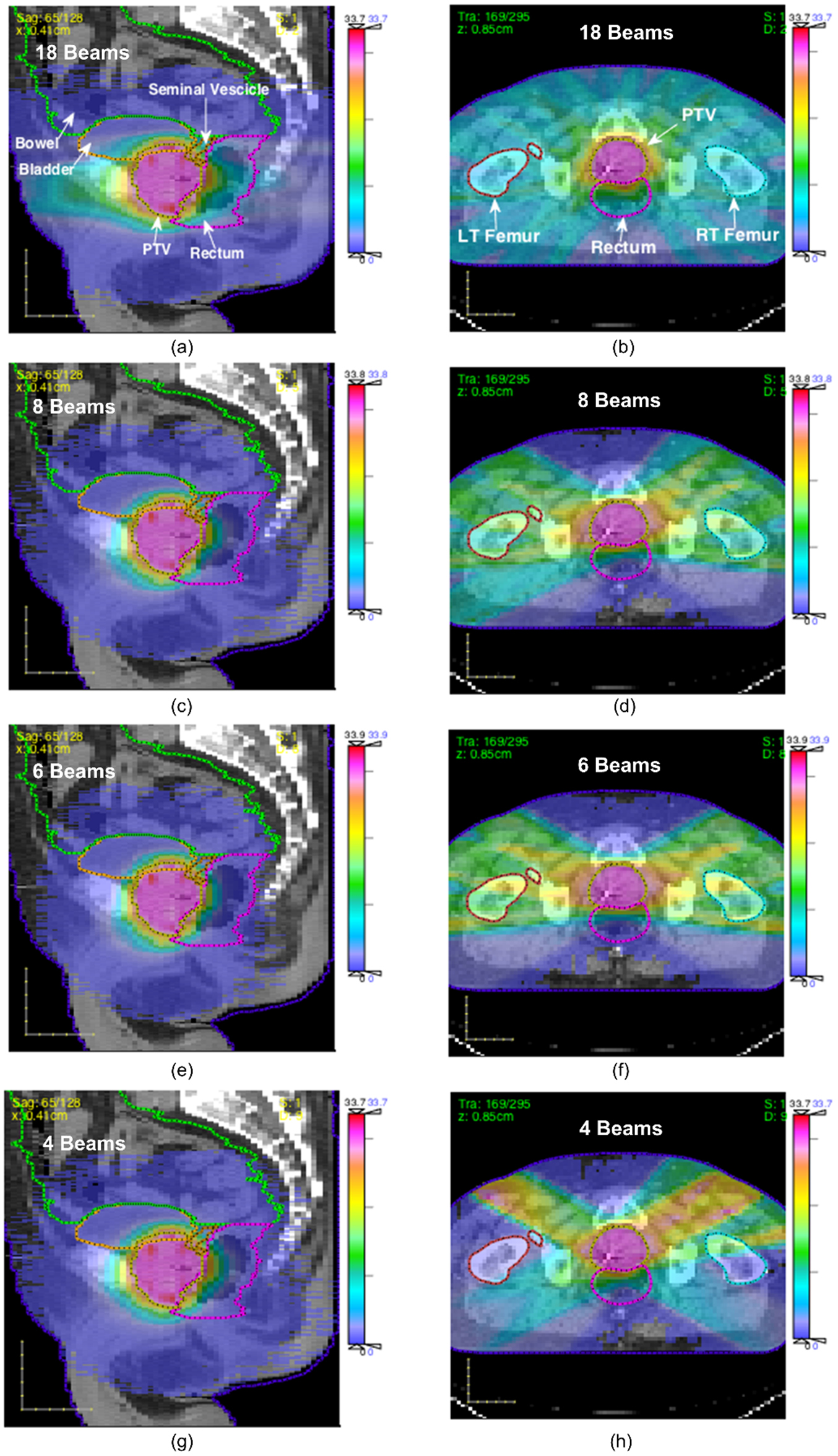 A new sparse optimization scheme for simultaneous beam angle and fluence map optimization in ...