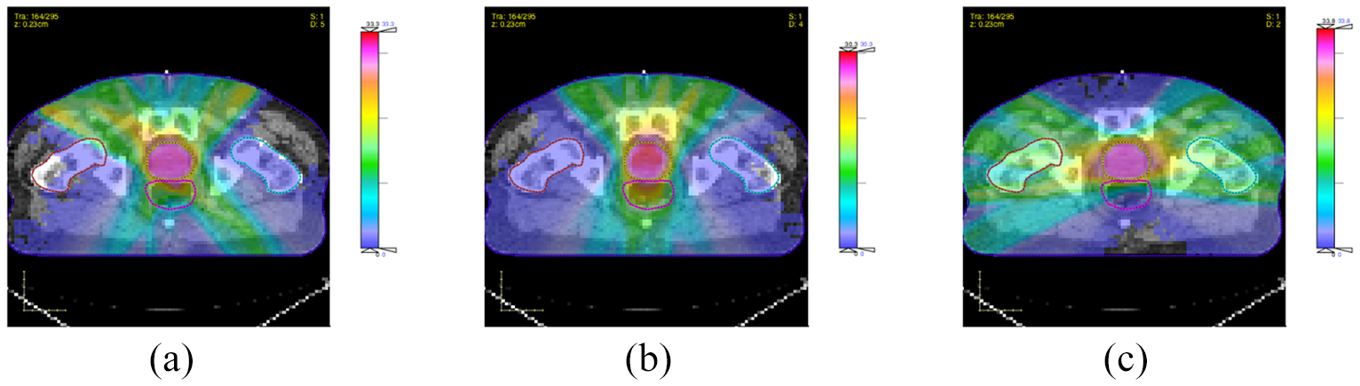 A new sparse optimization scheme for simultaneous beam angle and fluence map optimization in ...
