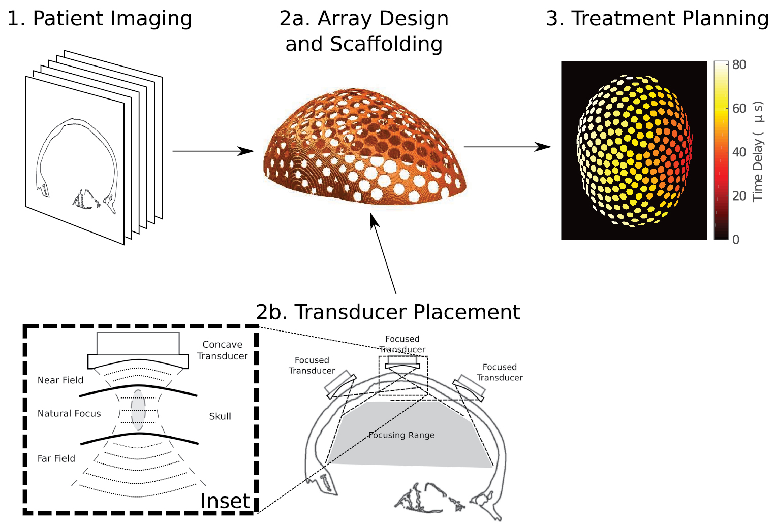 Design of patient-specific focused ultrasound arrays for non-invasive ...