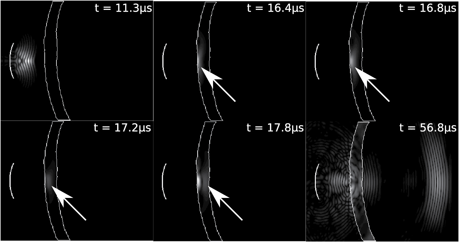 Design of patient-specific focused ultrasound arrays for non-invasive ...