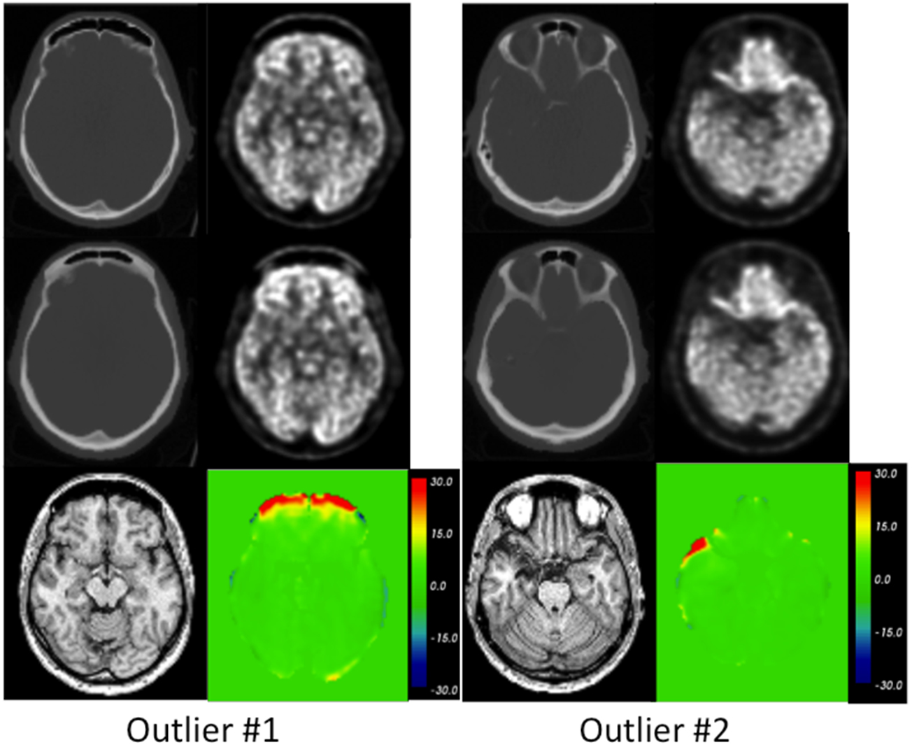 Multi-atlas attenuation correction supports full quantification of ...