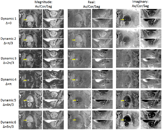 Visualization of gold fiducial markers in the prostate using phase ...
