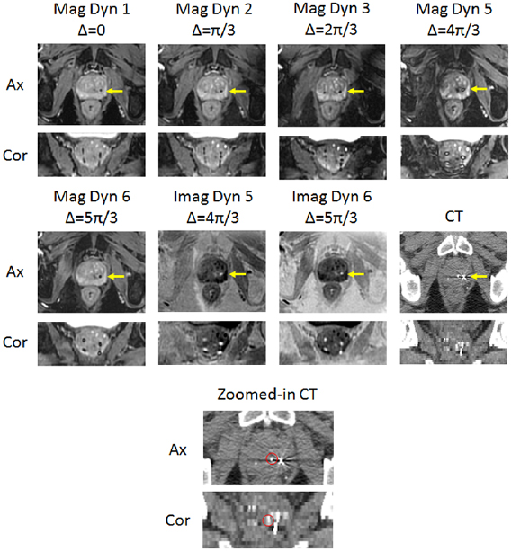 Visualization of gold fiducial markers in the prostate using phase ...