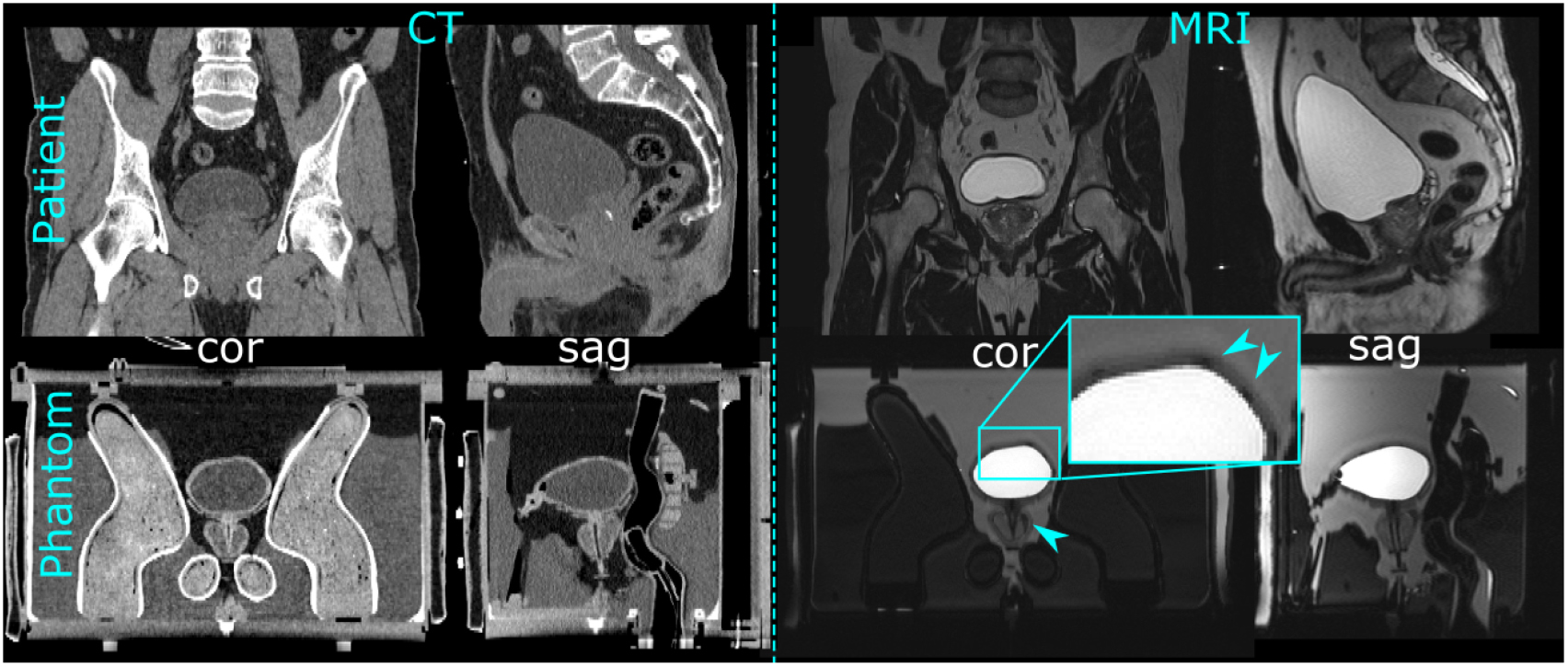 The ADAM-pelvis phantom—an anthropomorphic, deformable and multimodal ...