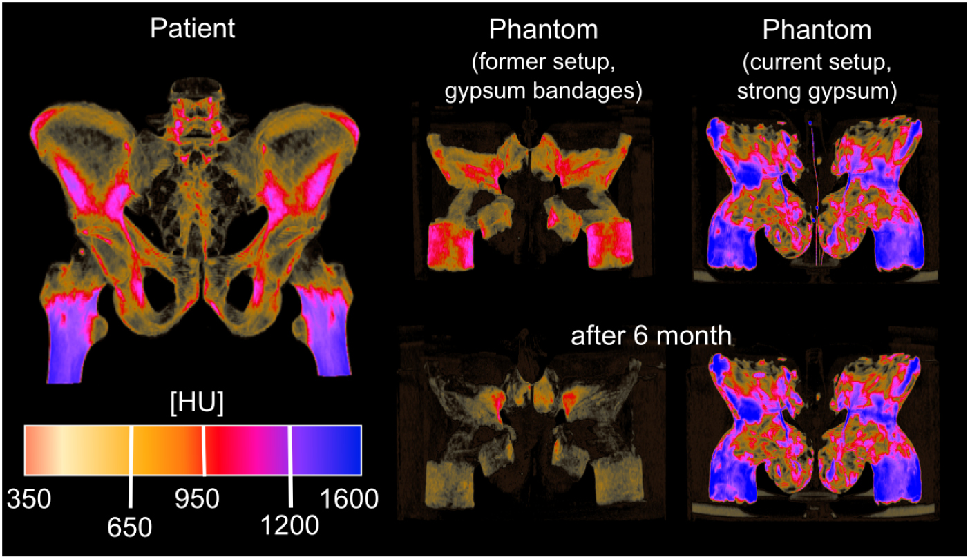The ADAM-pelvis phantom—an anthropomorphic, deformable and multimodal ...