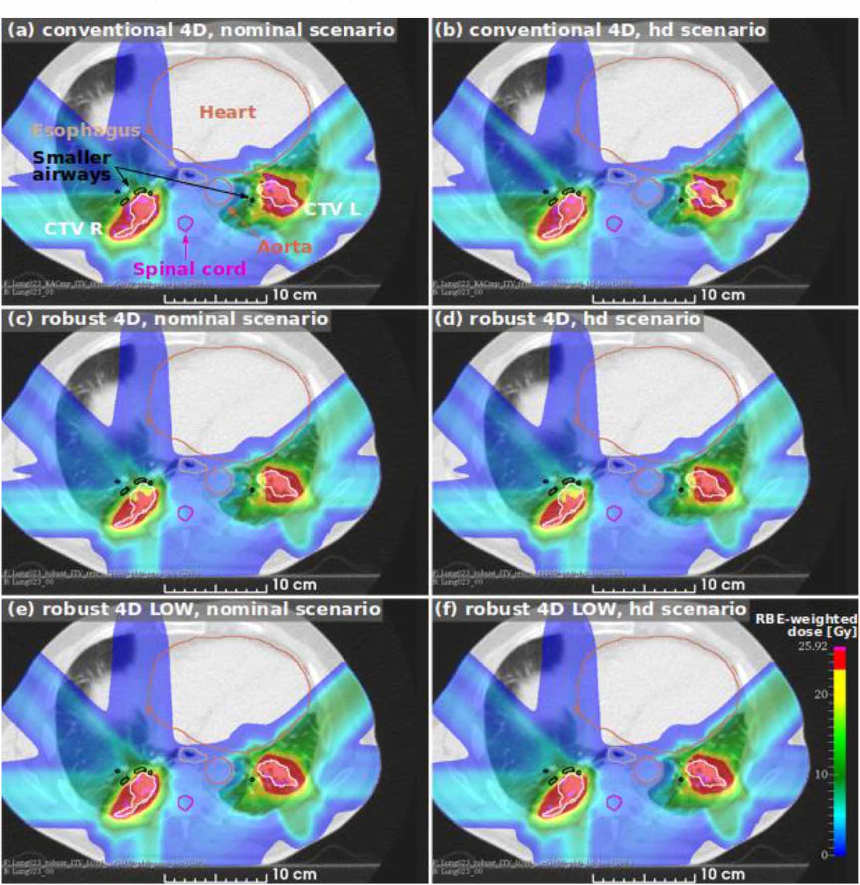 Robust treatment planning with 4D intensity modulated carbon ion ...