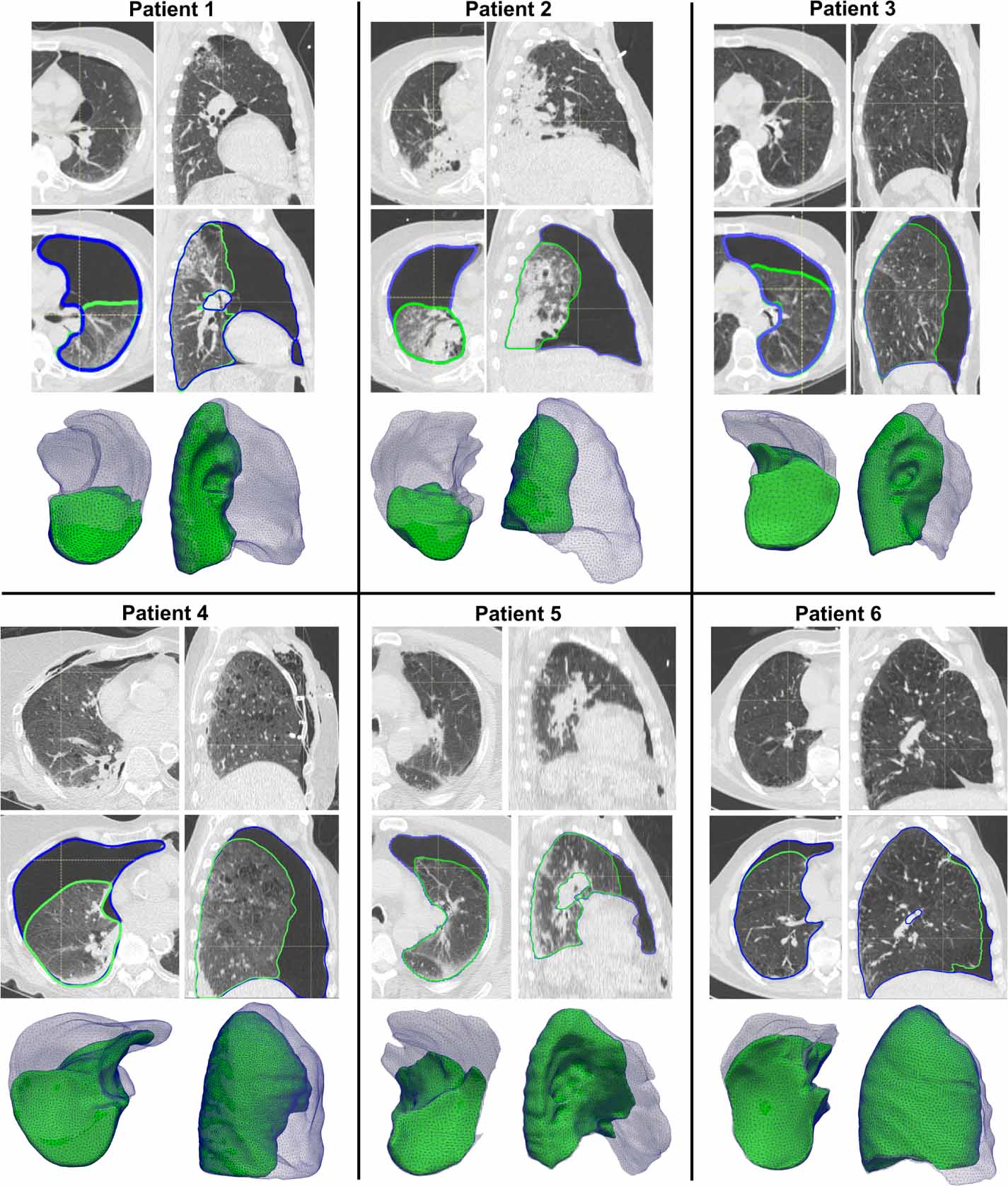 Preliminary evaluation of biomechanical modeling of lung deflation ...
