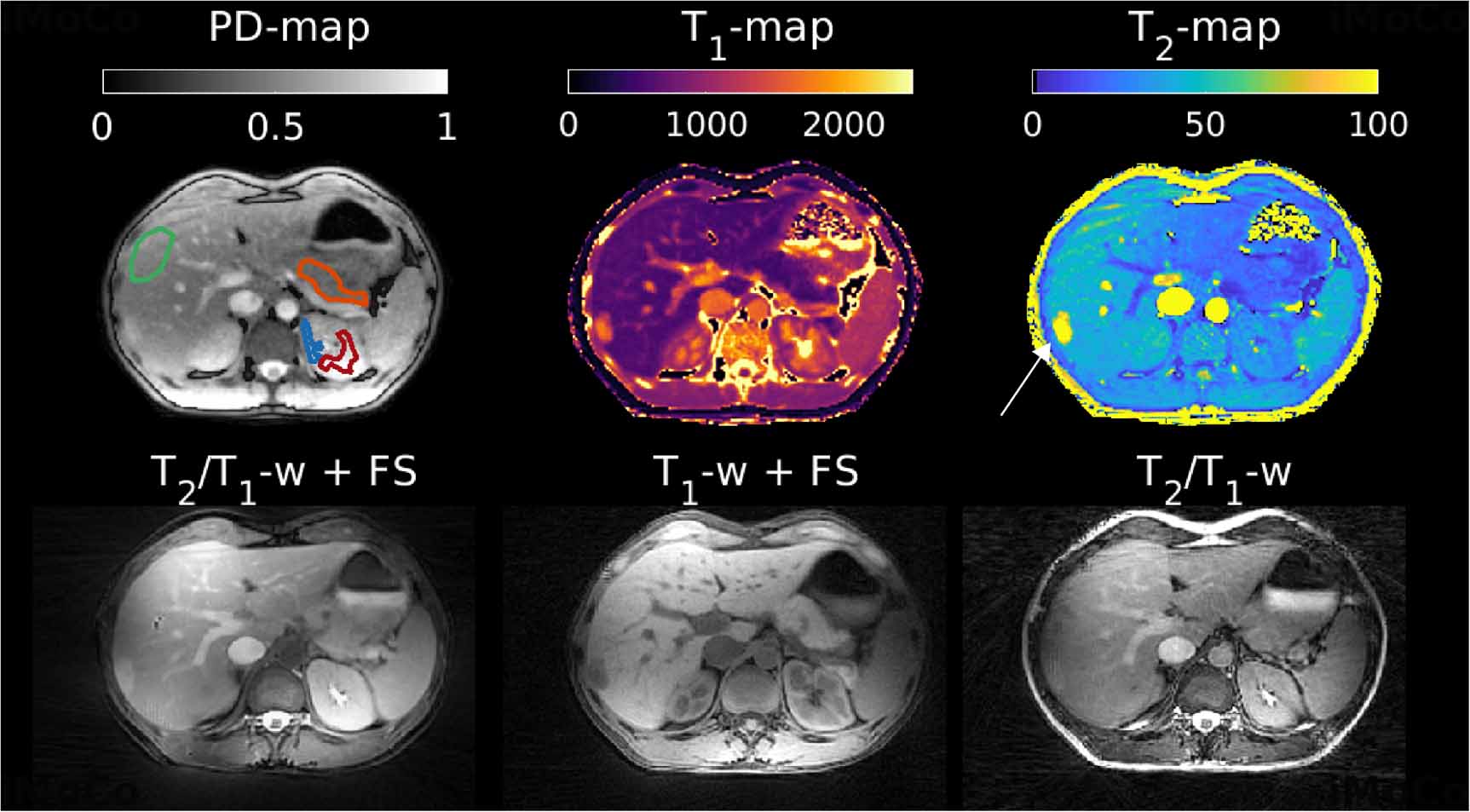 Technical feasibility of magnetic resonance fingerprinting on a 1.5T ...