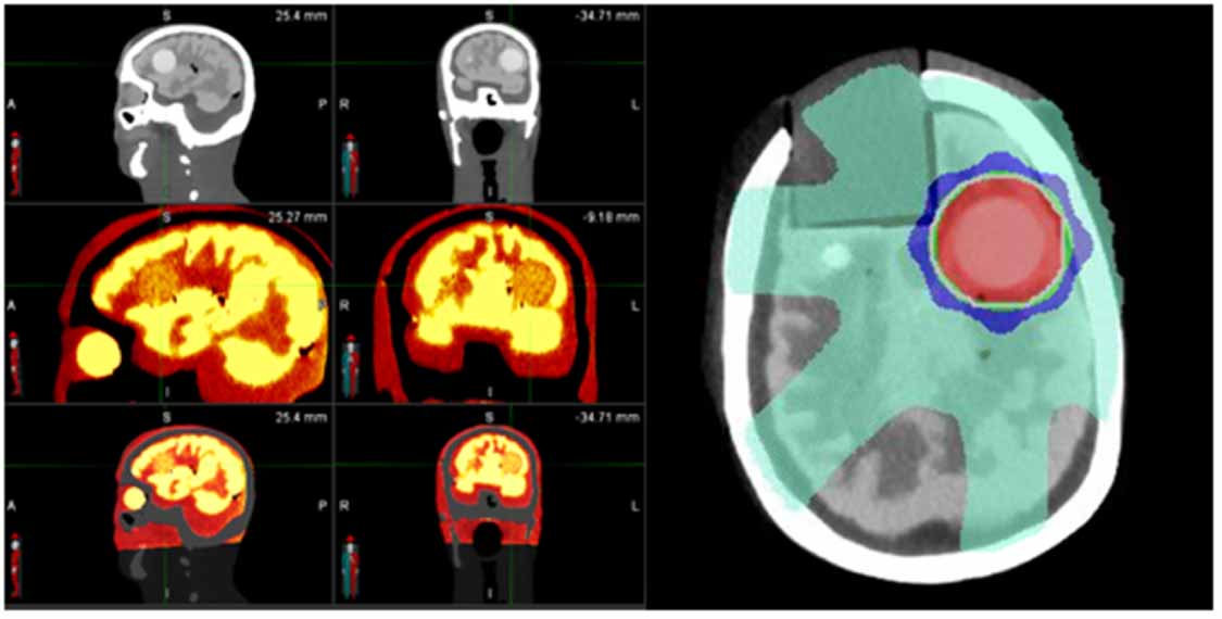 Tissue mimicking materials for imaging and therapy phantoms: a review ...