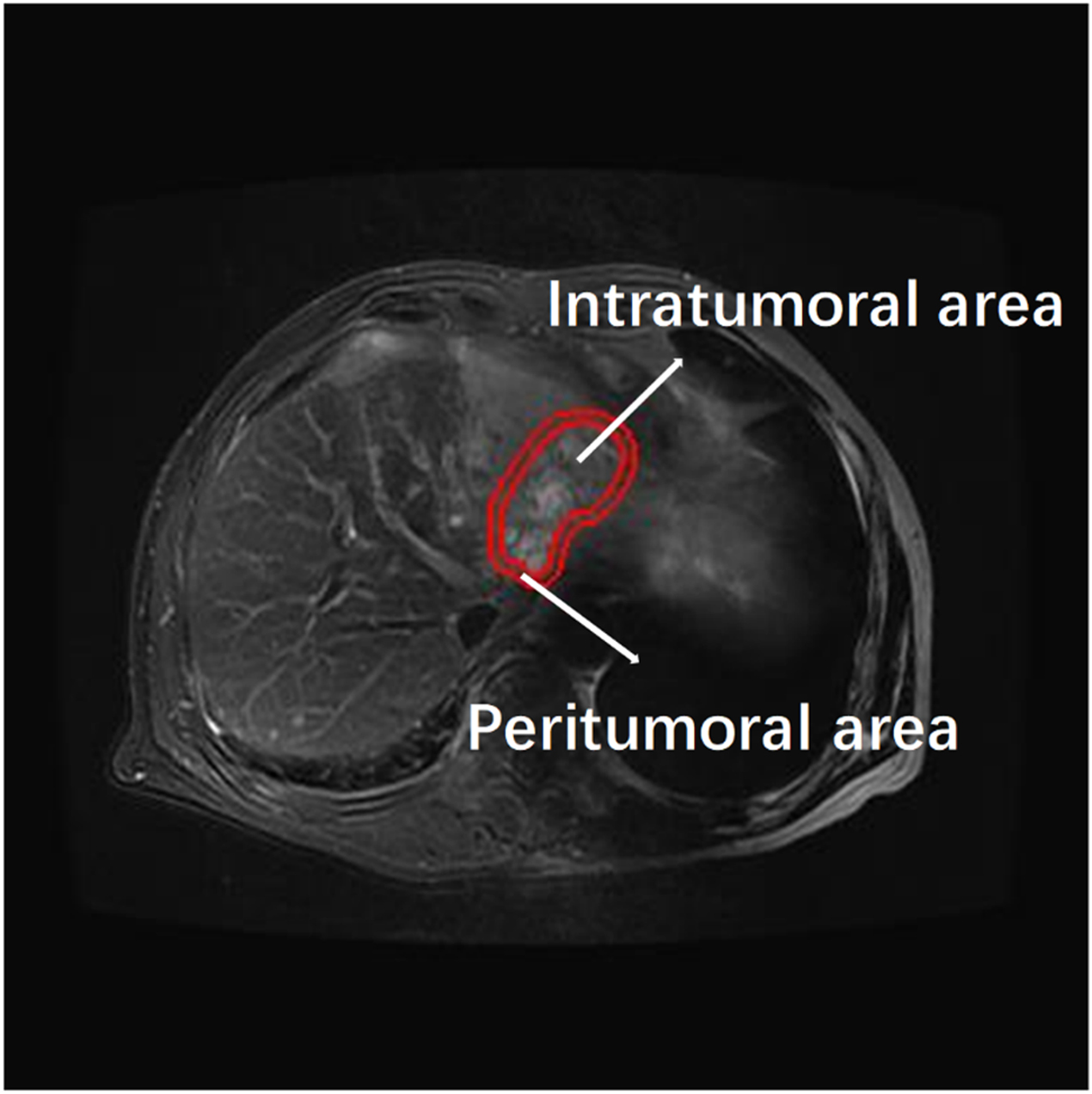 Integrating intratumoral and peritumoral features to predict tumor ...
