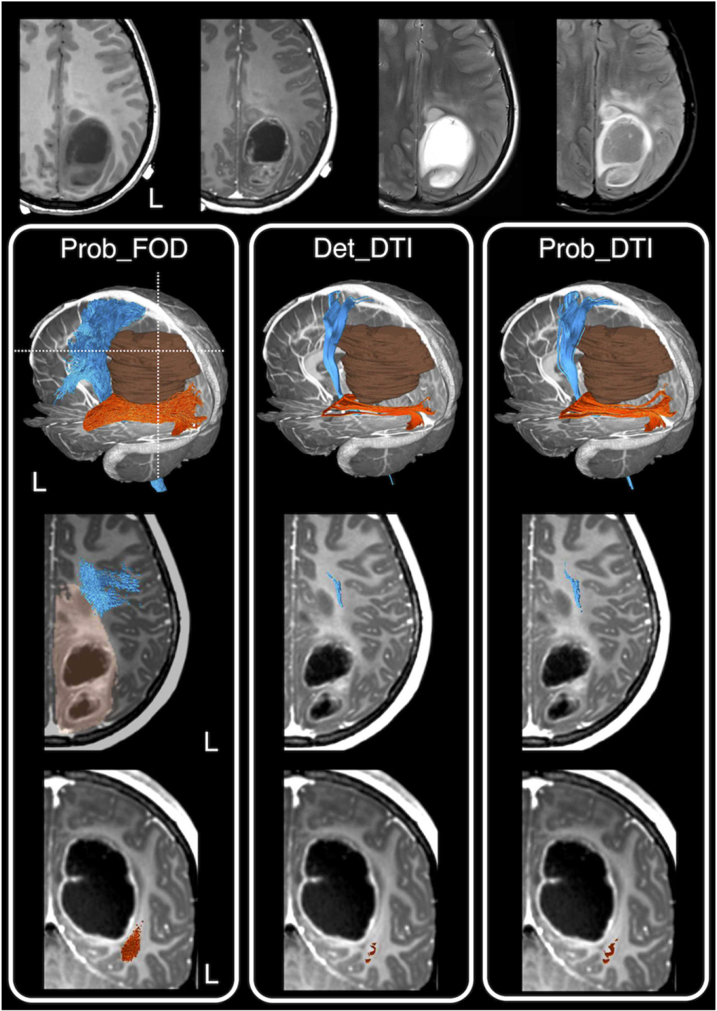 Diffusion MRI tractography for neurosurgery: the basics, current state ...