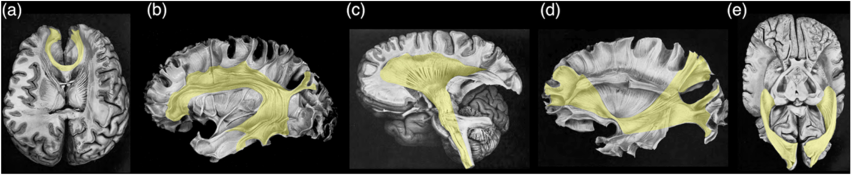 Diffusion MRI tractography for neurosurgery: the basics, current state ...