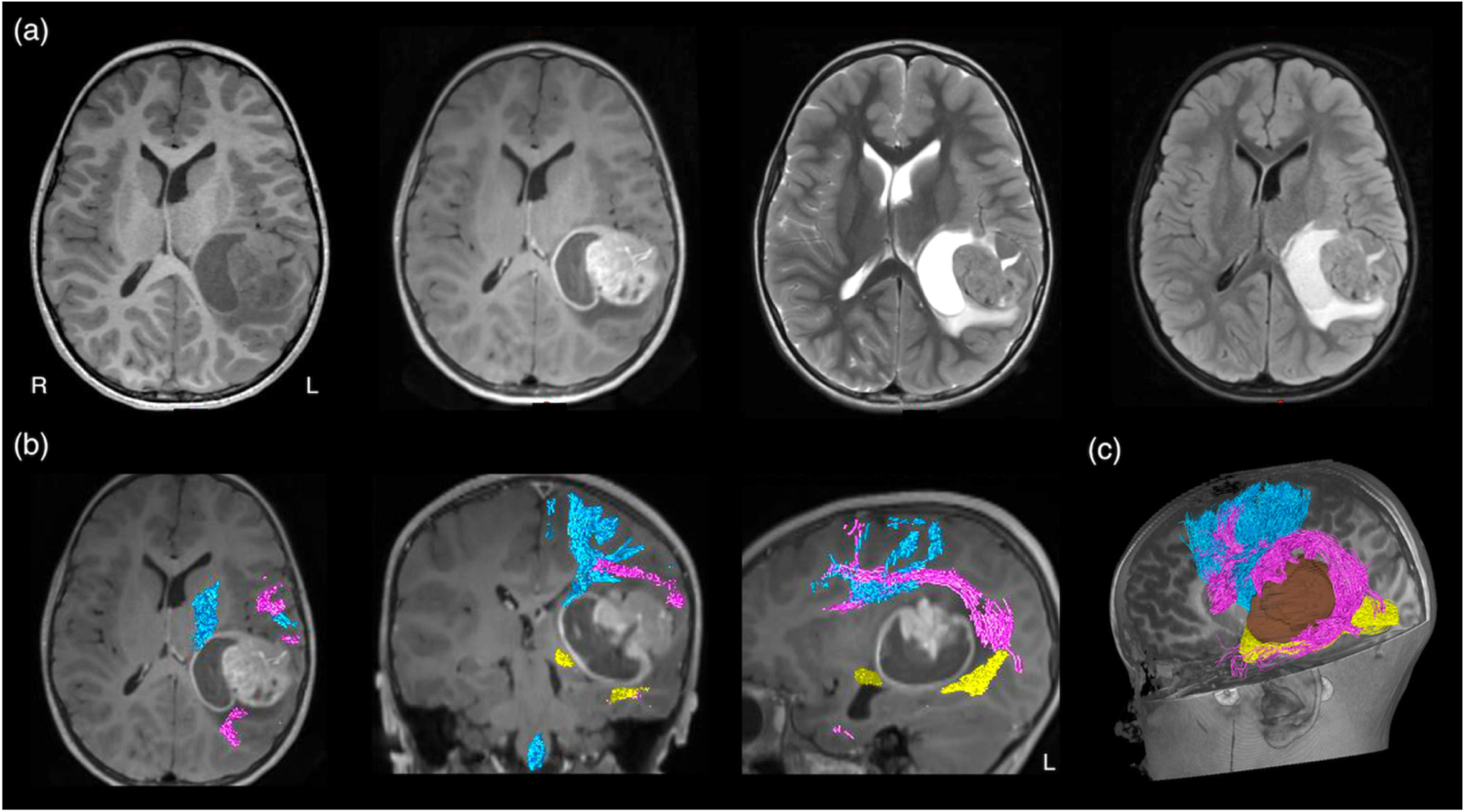 Diffusion MRI tractography for neurosurgery: the basics, current state ...