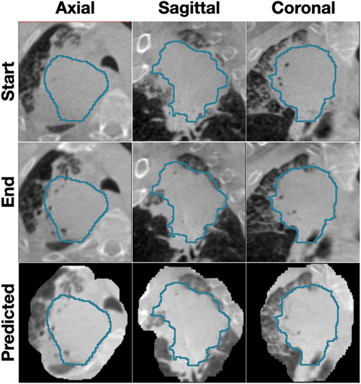 Early prediction of tumour-response to radiotherapy in NSCLC patients ...