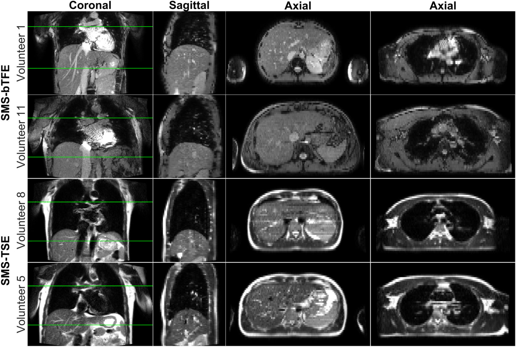 Simultaneous multi-slice accelerated 4D-MRI for radiotherapy guidance ...