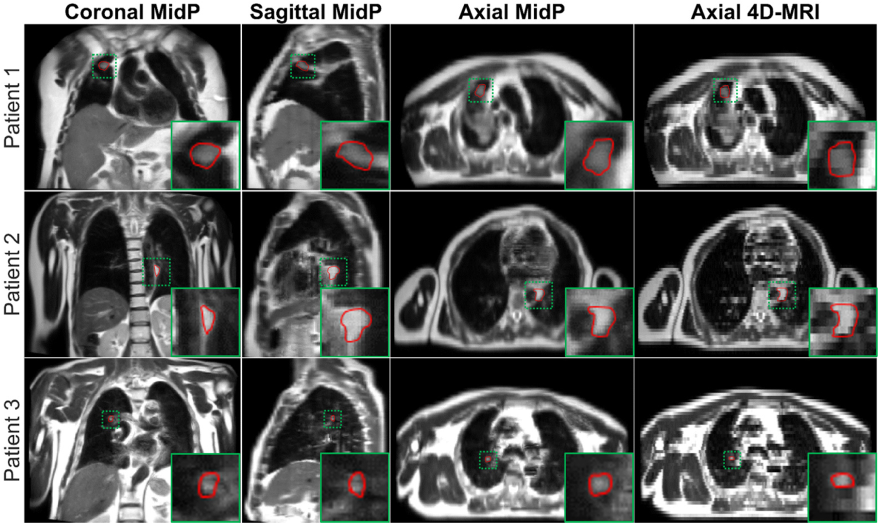 Simultaneous multi-slice accelerated 4D-MRI for radiotherapy guidance ...