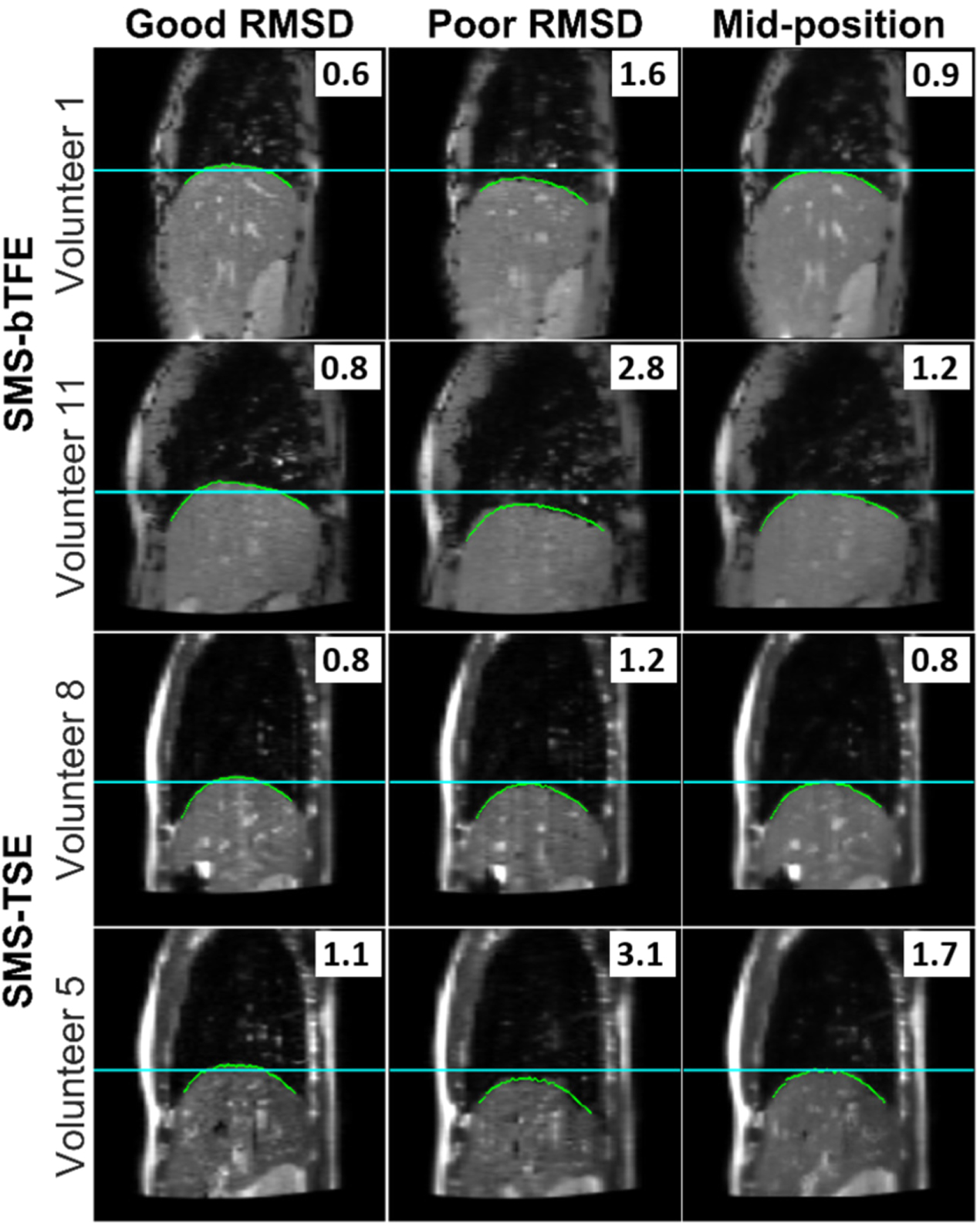 Simultaneous multi-slice accelerated 4D-MRI for radiotherapy guidance ...