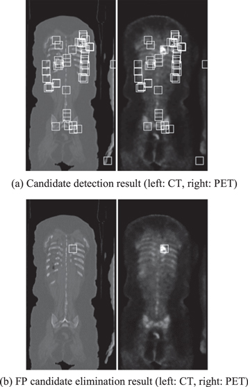 Automatic detection of primary and metastatic lesions on ...