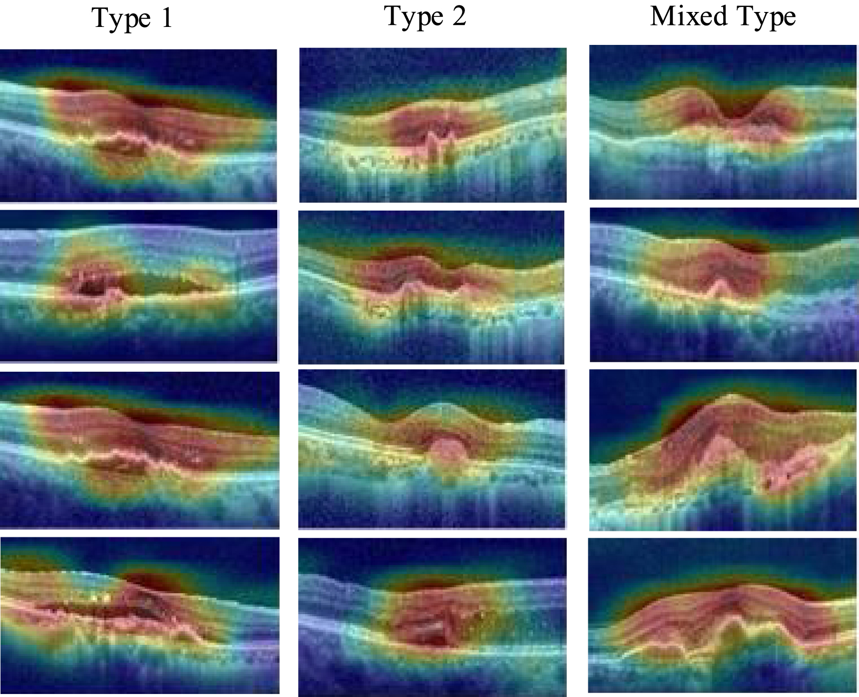 Feature enhancement network for CNV typing in optical coherence ...