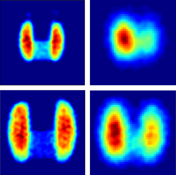 A mobile high-resolution gamma camera for therapeutic dose control ...
