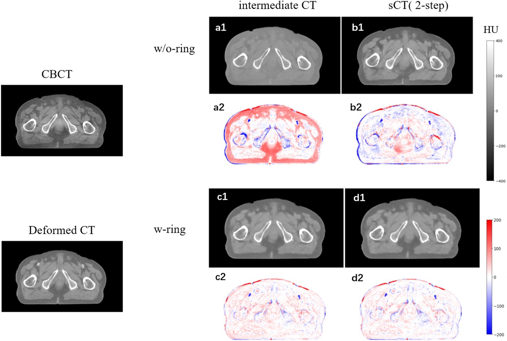 A two-step method to improve image quality of CBCT with phantom-based ...