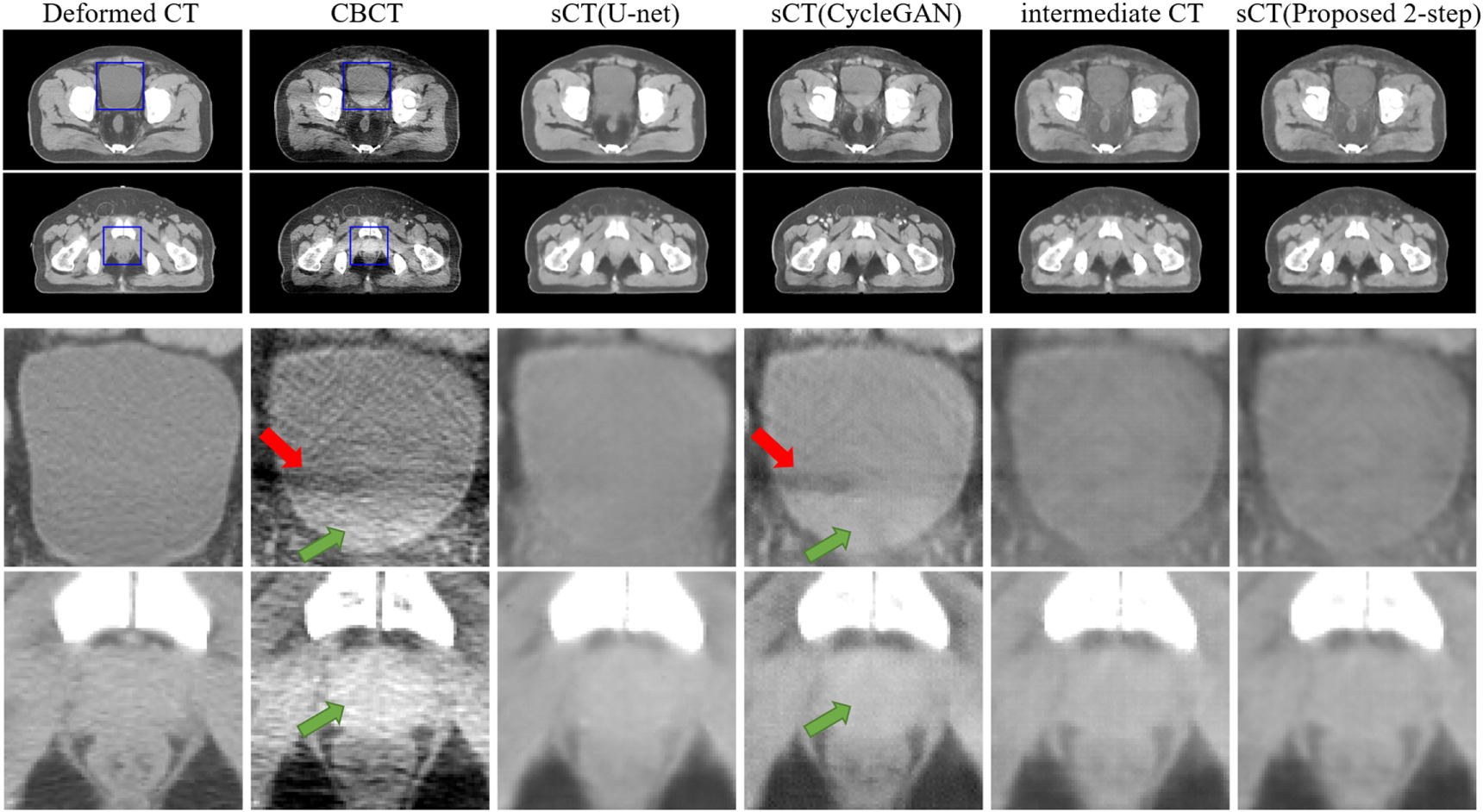 A two-step method to improve image quality of CBCT with phantom-based ...