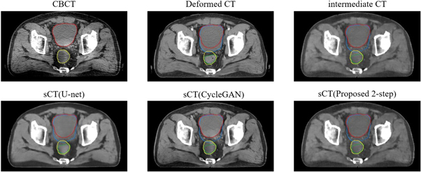 A two-step method to improve image quality of CBCT with phantom-based ...