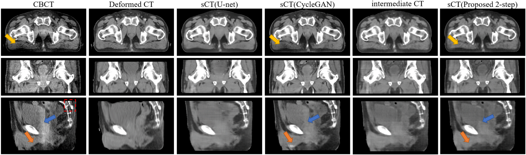 A two-step method to improve image quality of CBCT with phantom-based ...