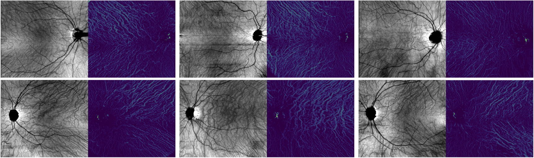 Synergistically segmenting choroidal layer and vessel using deep ...