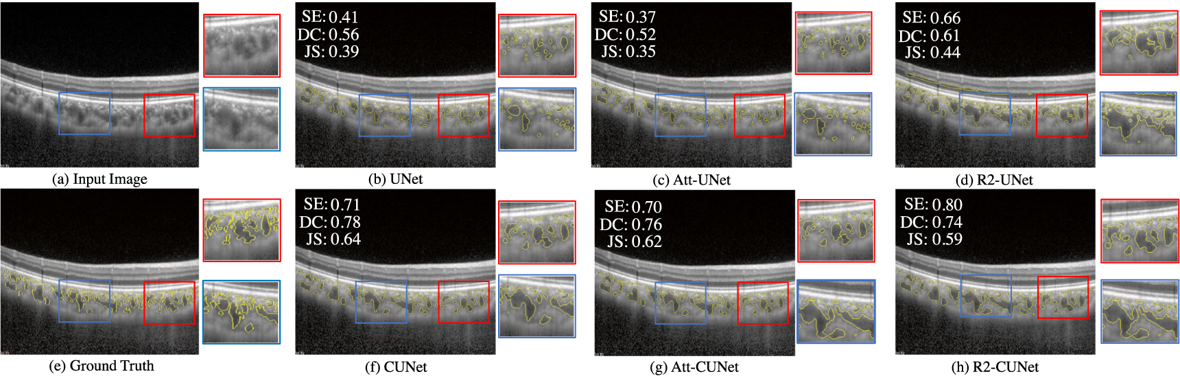 Synergistically segmenting choroidal layer and vessel using deep learning for choroid structure ...