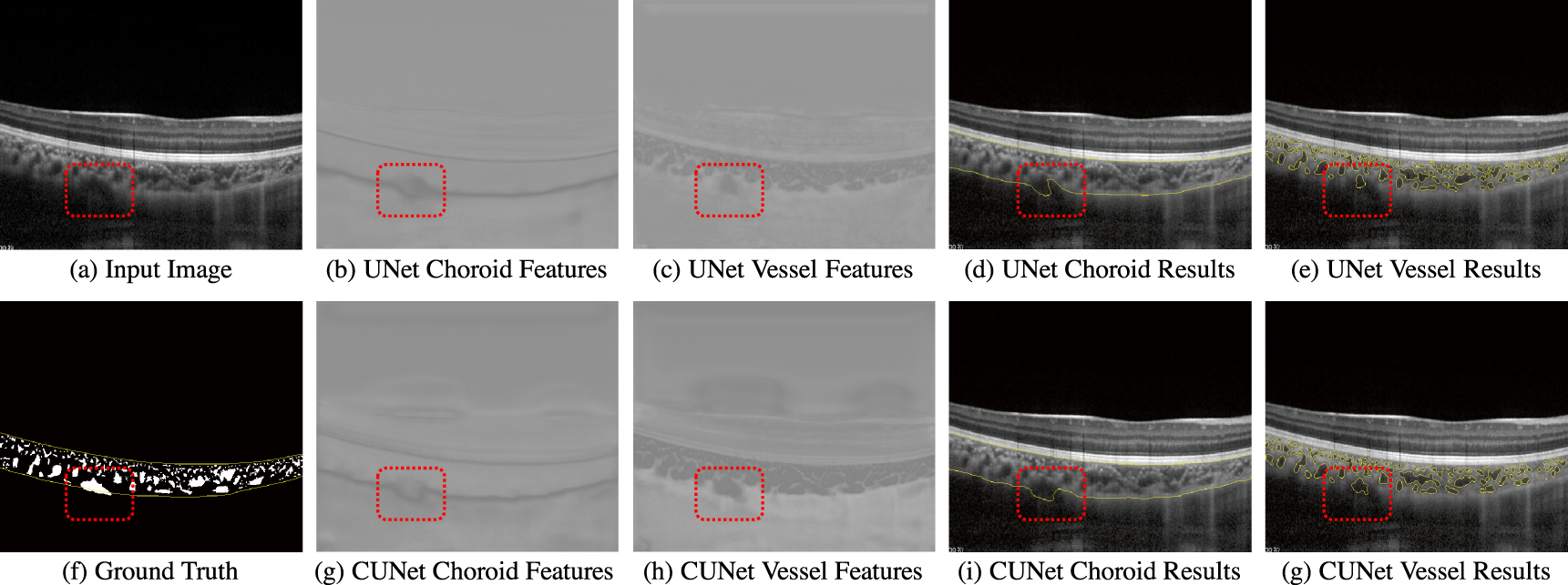 Synergistically segmenting choroidal layer and vessel using deep learning for choroid structure ...