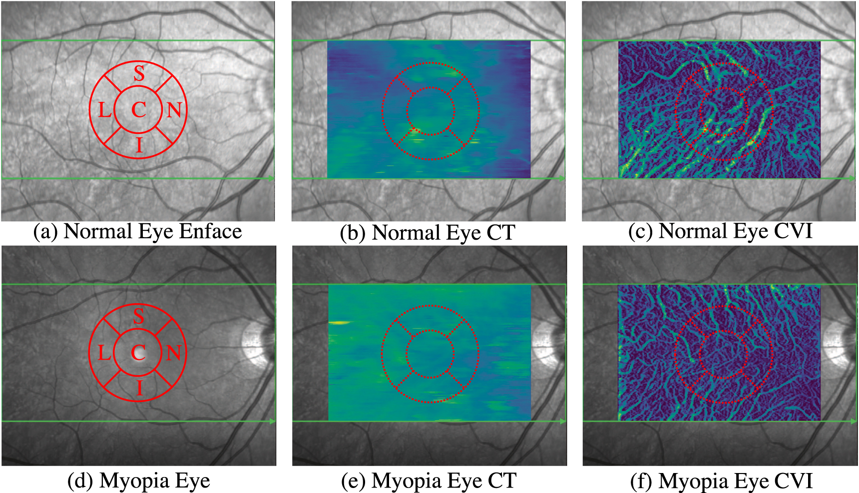 Synergistically segmenting choroidal layer and vessel using deep learning for choroid structure ...