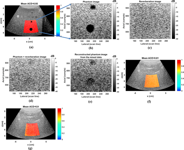 Reverberation clutter signal suppression in ultrasound attenuation ...