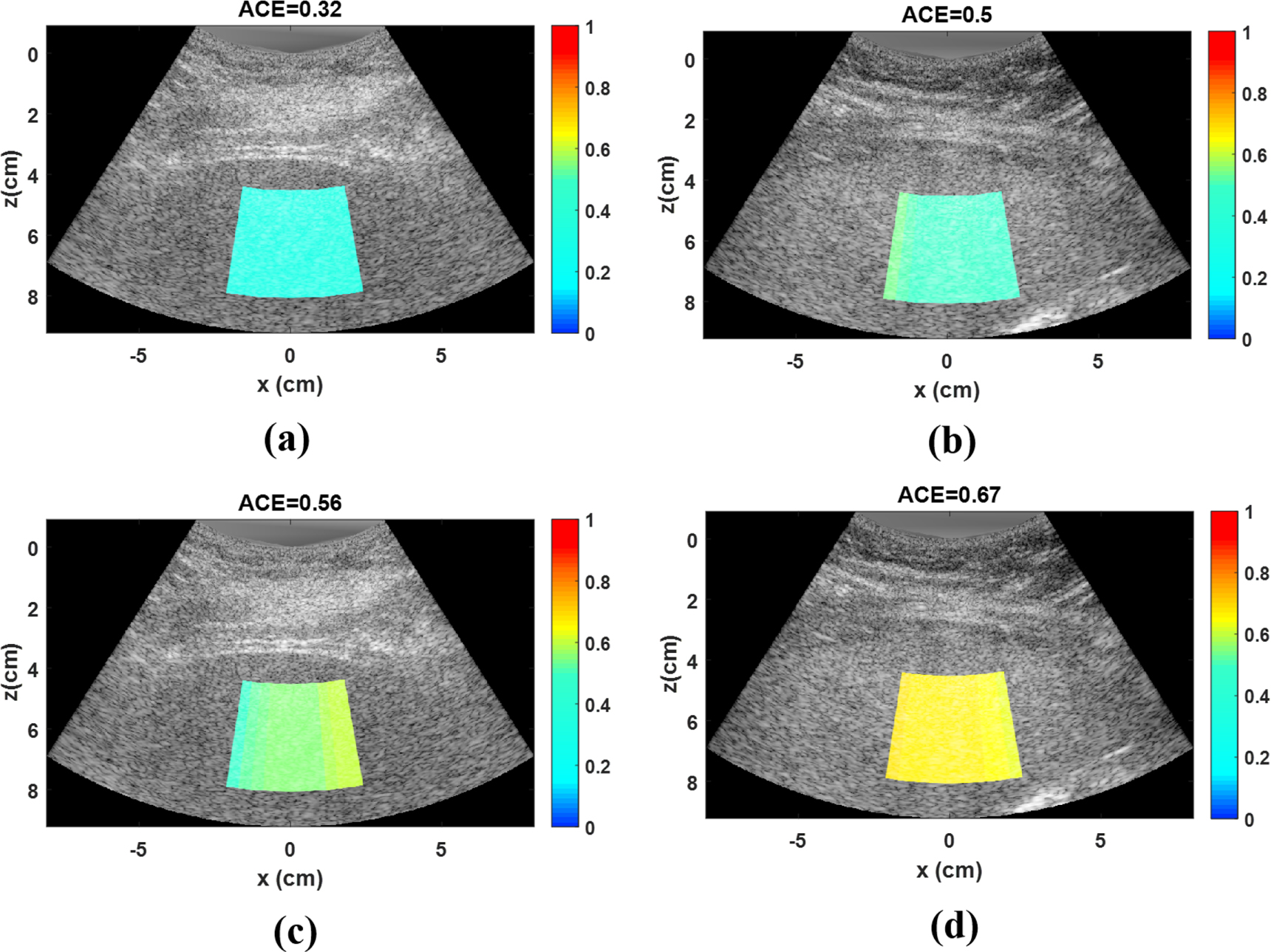 Reverberation clutter signal suppression in ultrasound attenuation ...