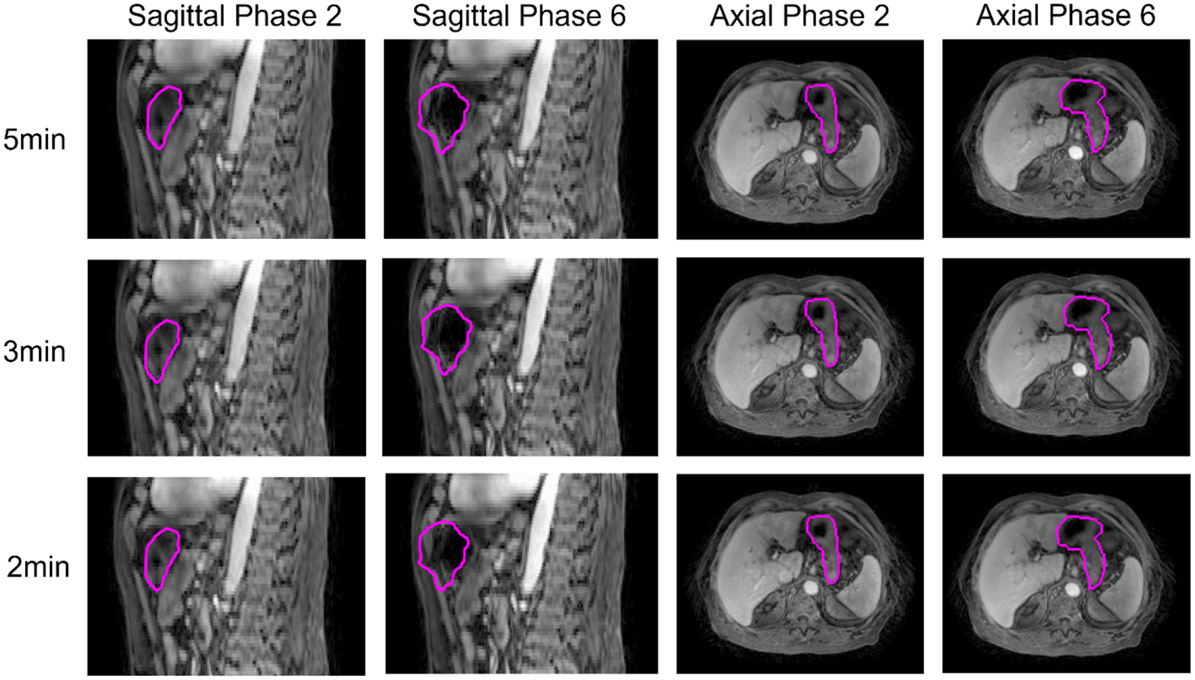 Real-time prediction of stomach motions based upon gastric contraction ...